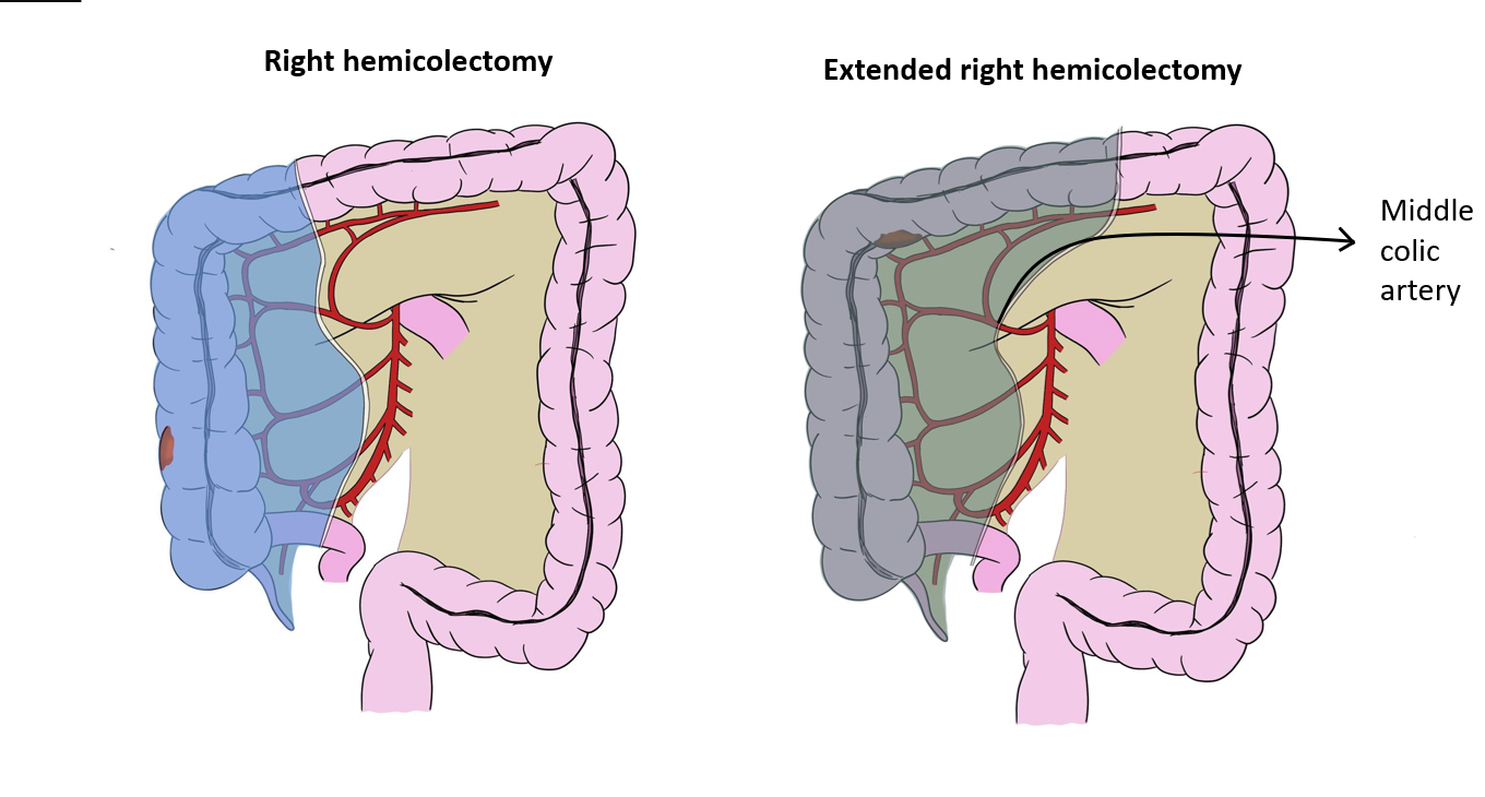 Right Hemicolectomy Right Hemicolectomy